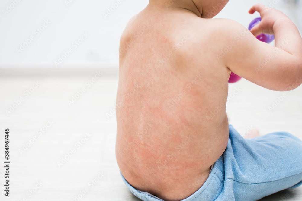 Roseola also known as six disease. Skin rash on baby back. Stock Photo ...