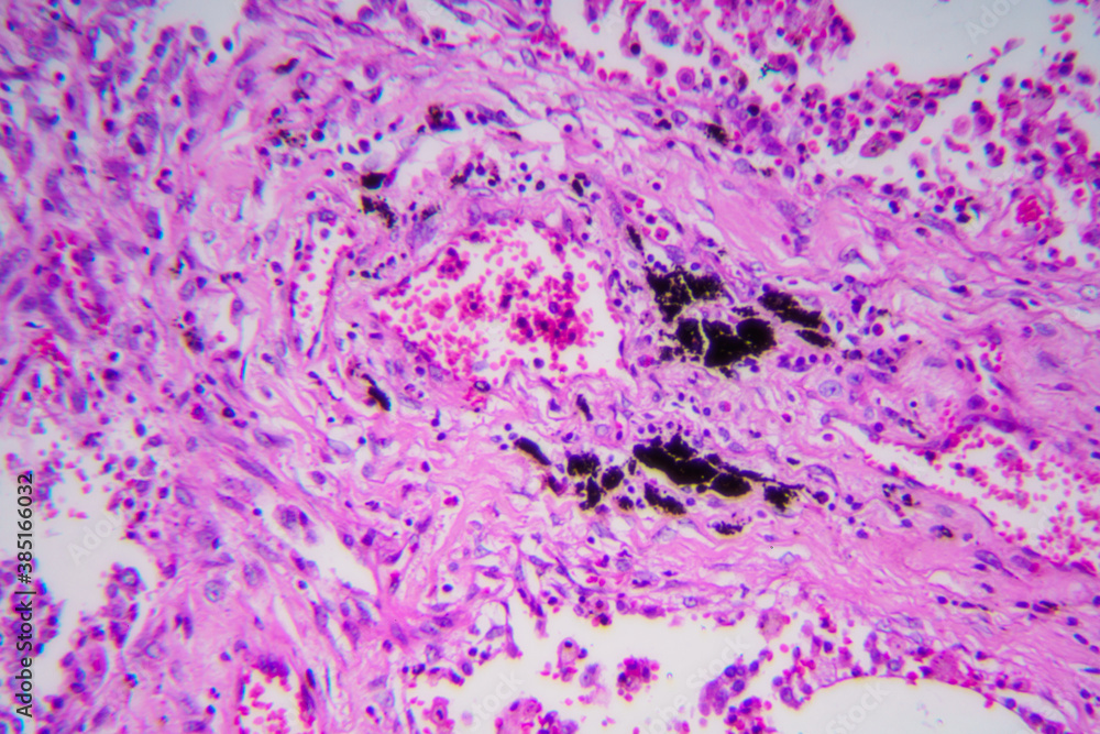 Viral pneumonia disease human cells Stock Photo | Adobe Stock