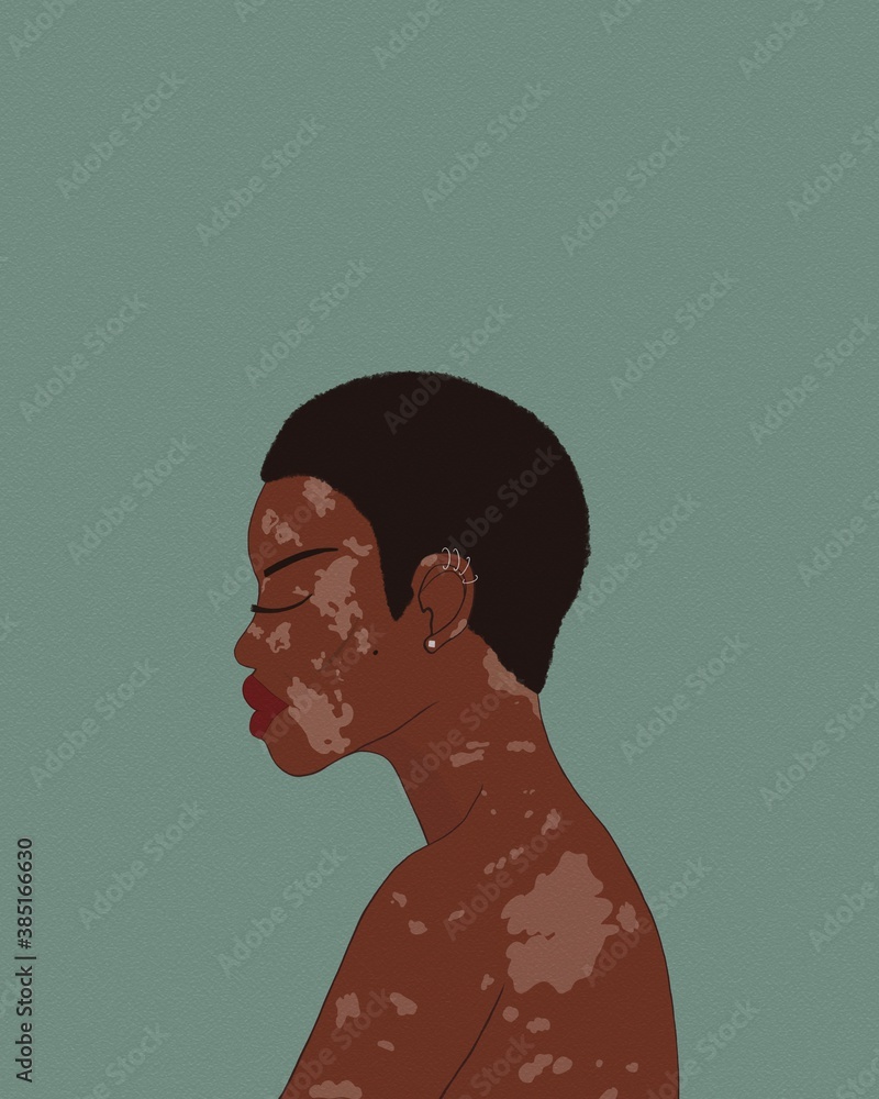 drawing of a girl with vitiligo Stock Photo | Adobe Stock