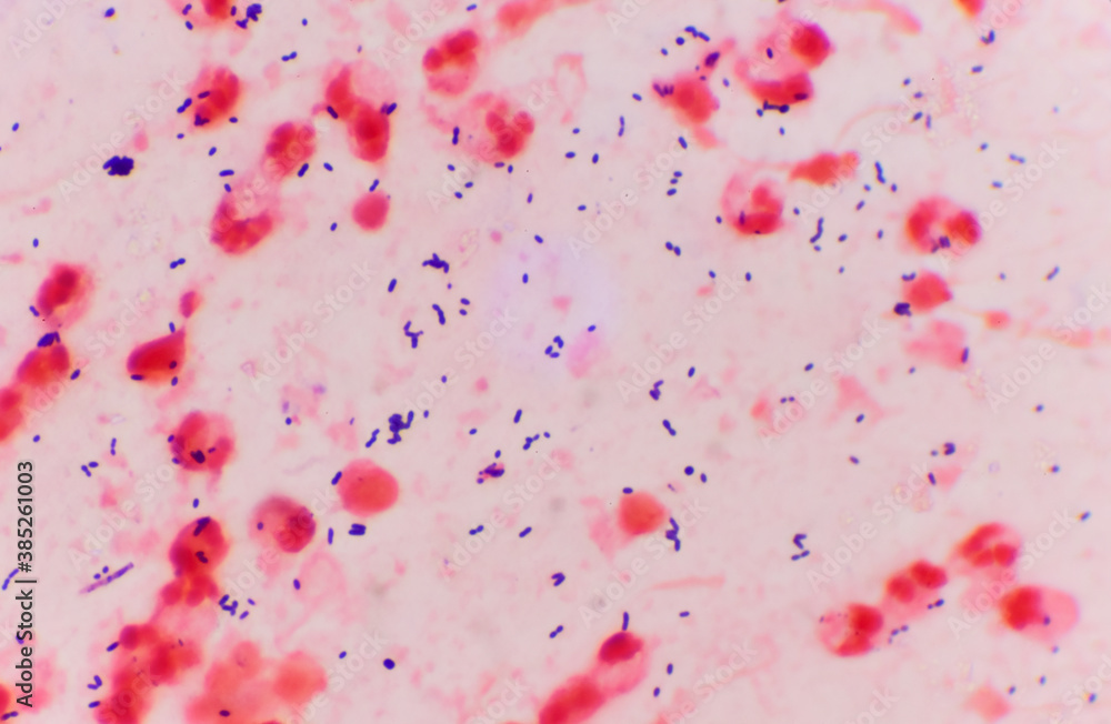 Bacteria Gram positive in sputum gram stain. Stock Photo | Adobe Stock