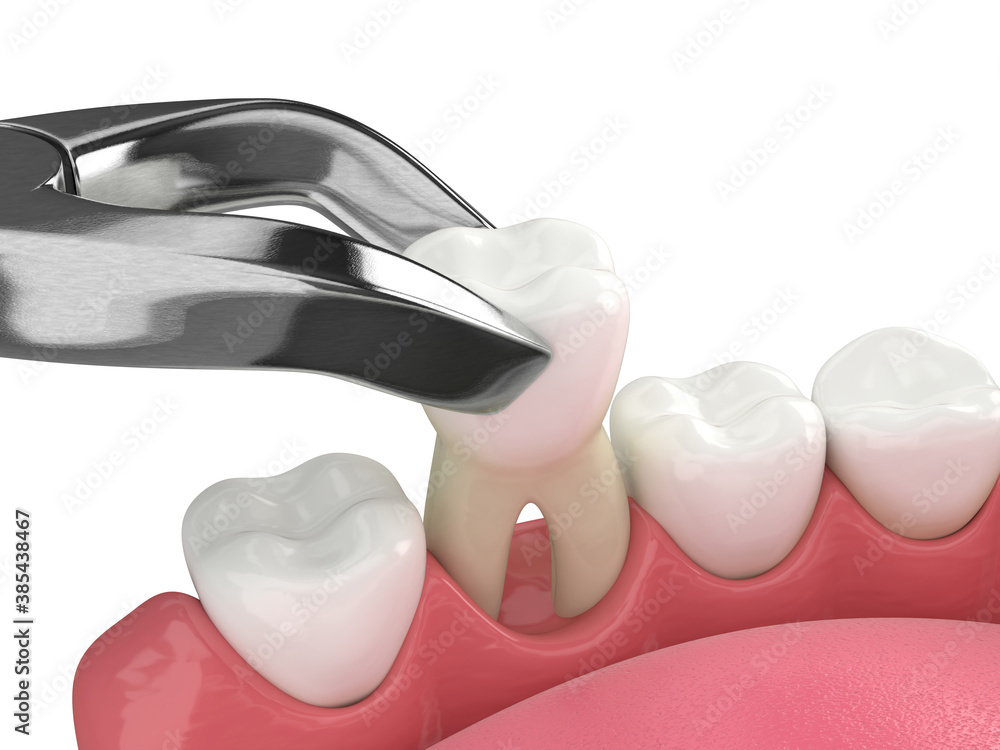 3d render of lower jaw with tooth extraction Stock Illustration | Adobe ...