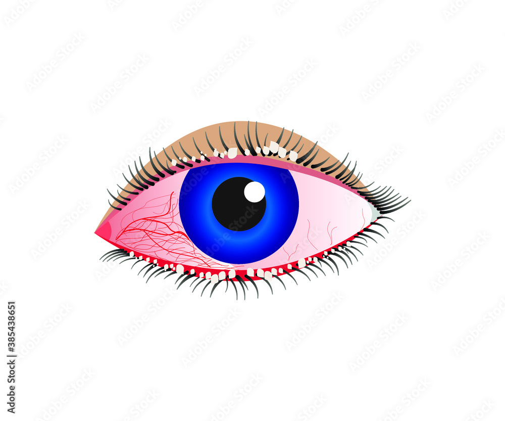 Sore eyes, inflamed reddened eyes, red eyes icon. Vector illustration ...