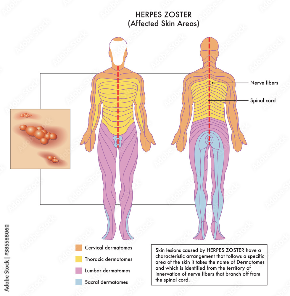 Medical diagram of affected skin areas of Herpes Zoster with ...