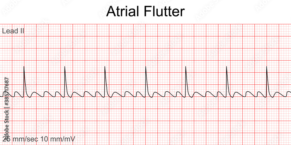 Electrocardiogram show Atrial flutter pattern. Cardiac fibrillation ... Electrocardiogram show Atrial flutter pattern. Cardiac fibrillation ...