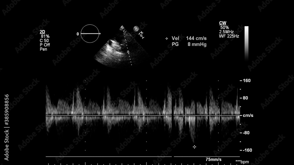 Image of the heart in gray-scale mode during transesophageal ultrasound ...