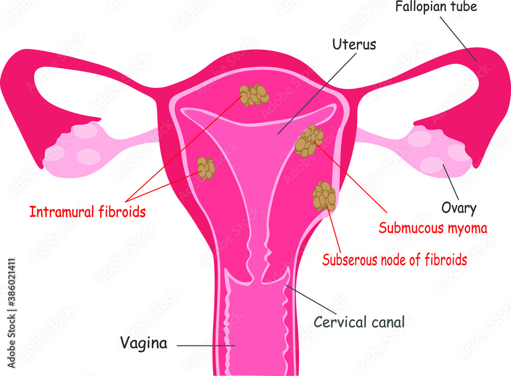 Types of uterine fibroids: intramural, subserosal, and submucosal ...