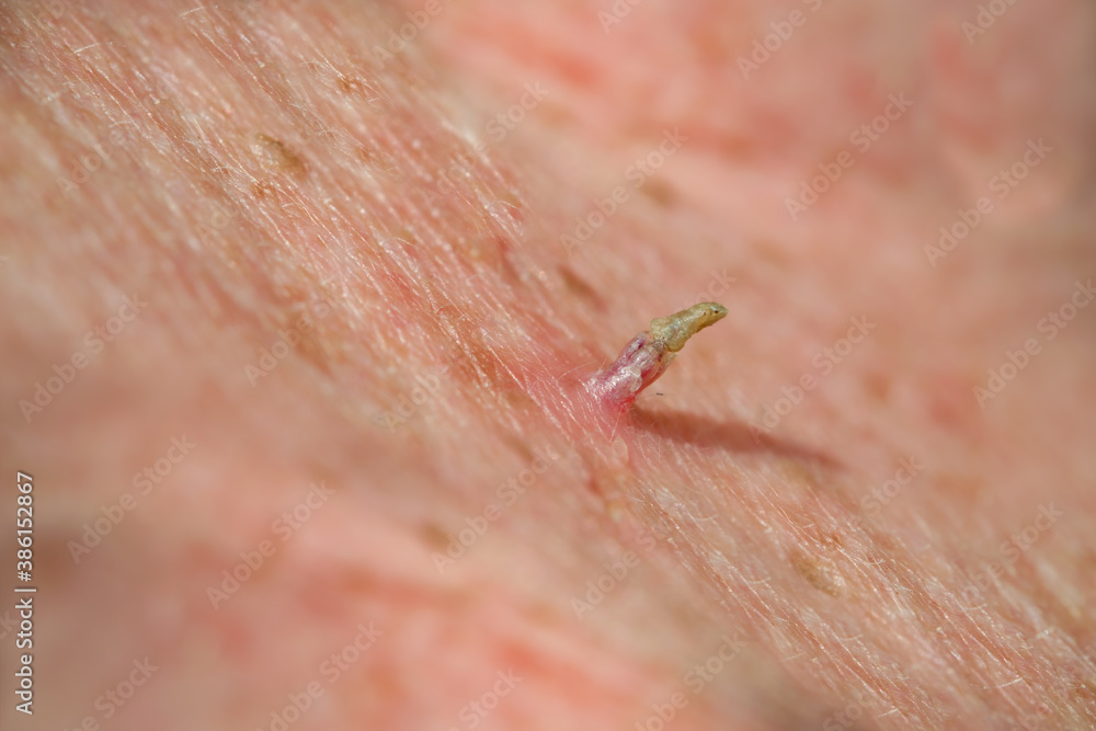 Pointed papilloma and brown spots on the skin of an old woman close-up ...