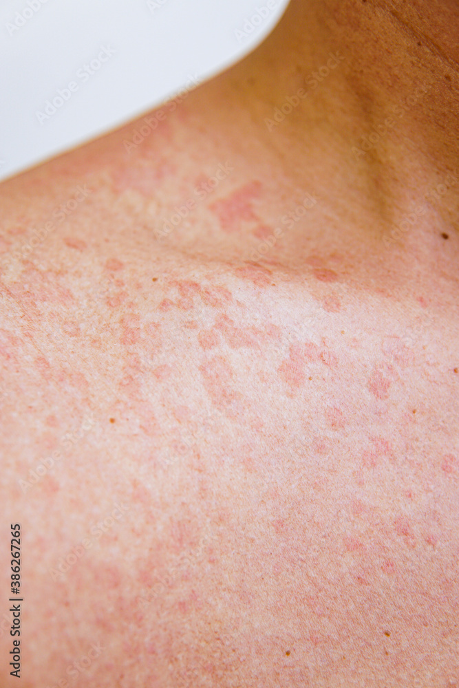 red inflamed skin on a man's body. skin fungus causing white blotches ...