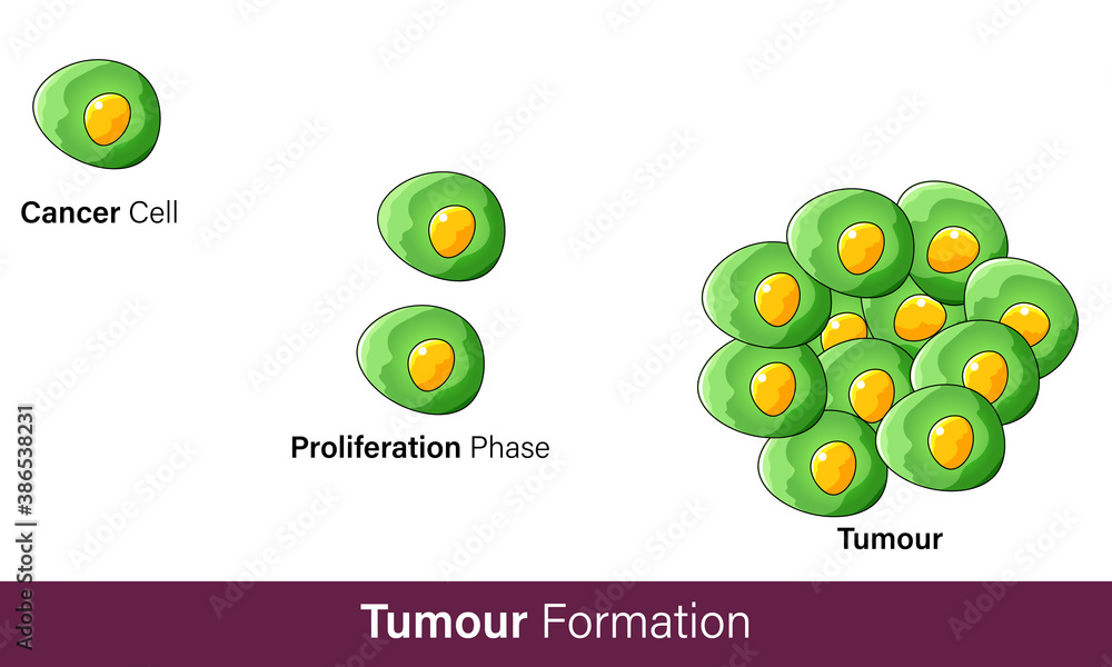 cancer cell formation due to mutagenic even vector concept inphograph ...