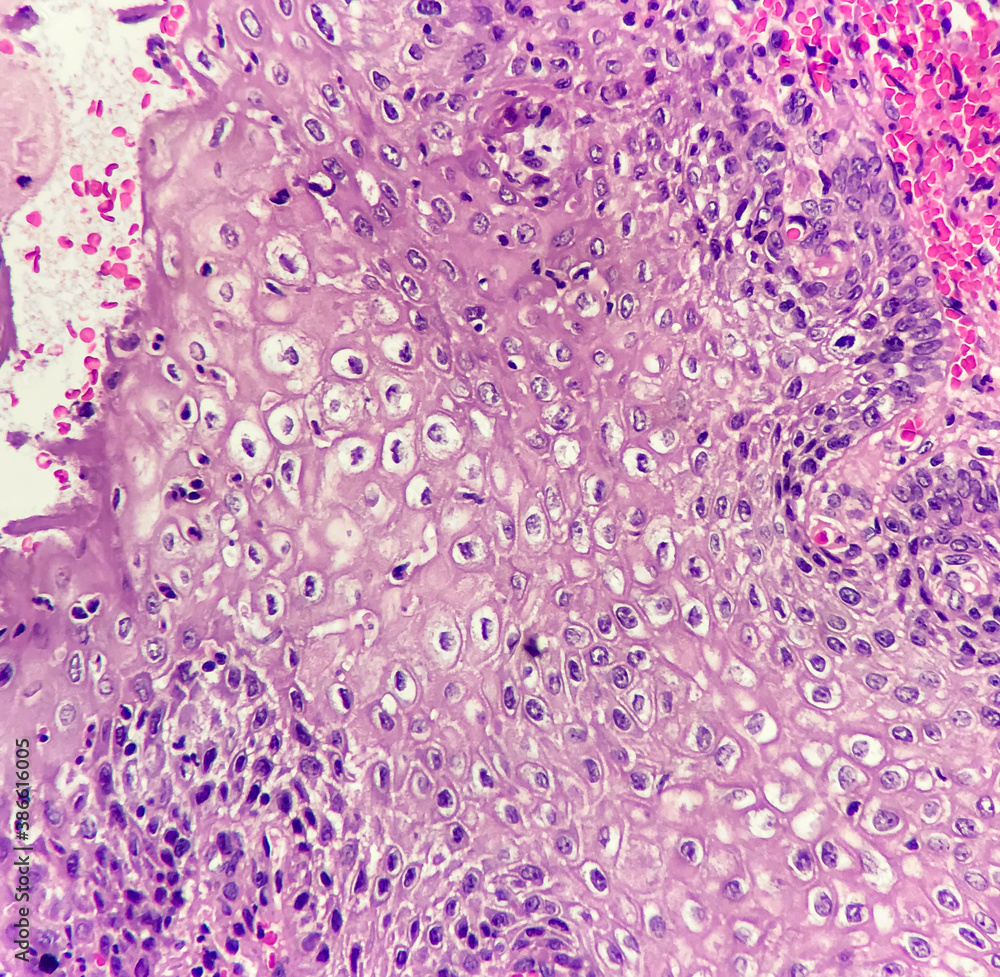 Cervix displays HPV (human papilloma virus) cytopathic effect, magnification 400x, photo under ...