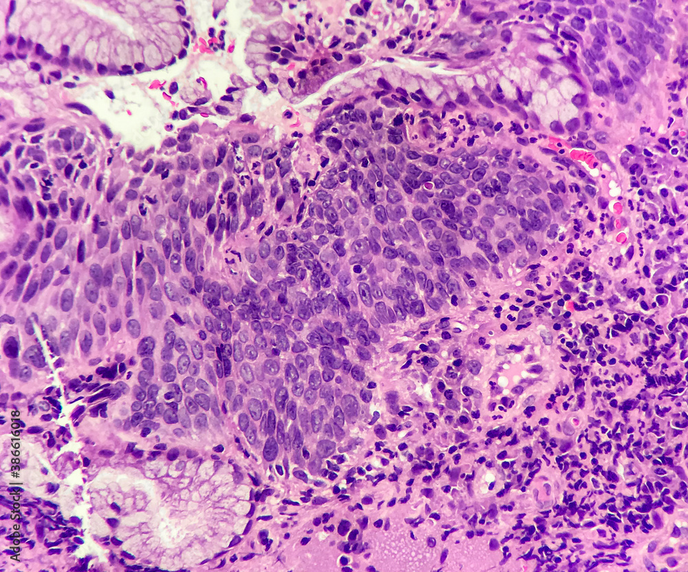 Cervix reveals high-grade squamous dysplasia, magnification 400x, photo ...
