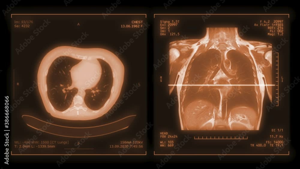 Video Stock CT Chest or CT Scan of Human Chest Coronal MIP View with Lung filter technique for ...