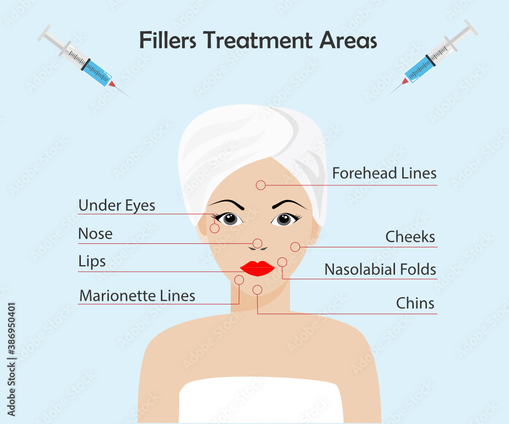 Dermal Fillers or botox Injection Treatment areas. Beautiful woman's ...