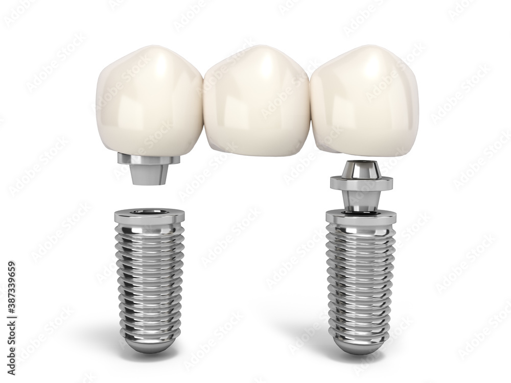 Tooth human multitooth implant Dental concept Human teeth or dentures ...