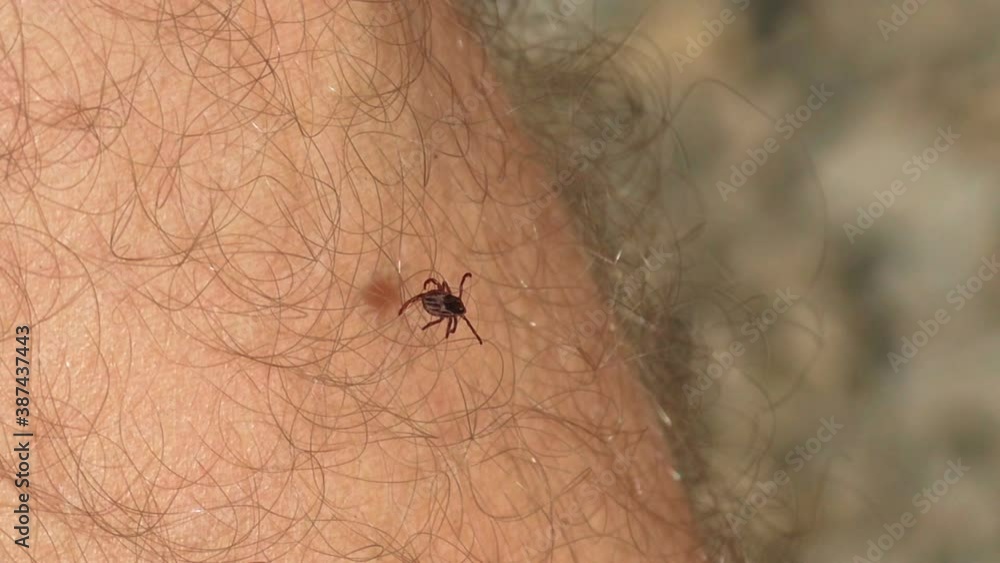 Insect parasite mite crawls on a man's leg. Tick on the skin. vídeo de ...