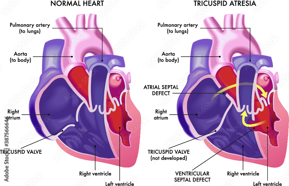 Medical illustration that compare a normal heart with a heart affected ...