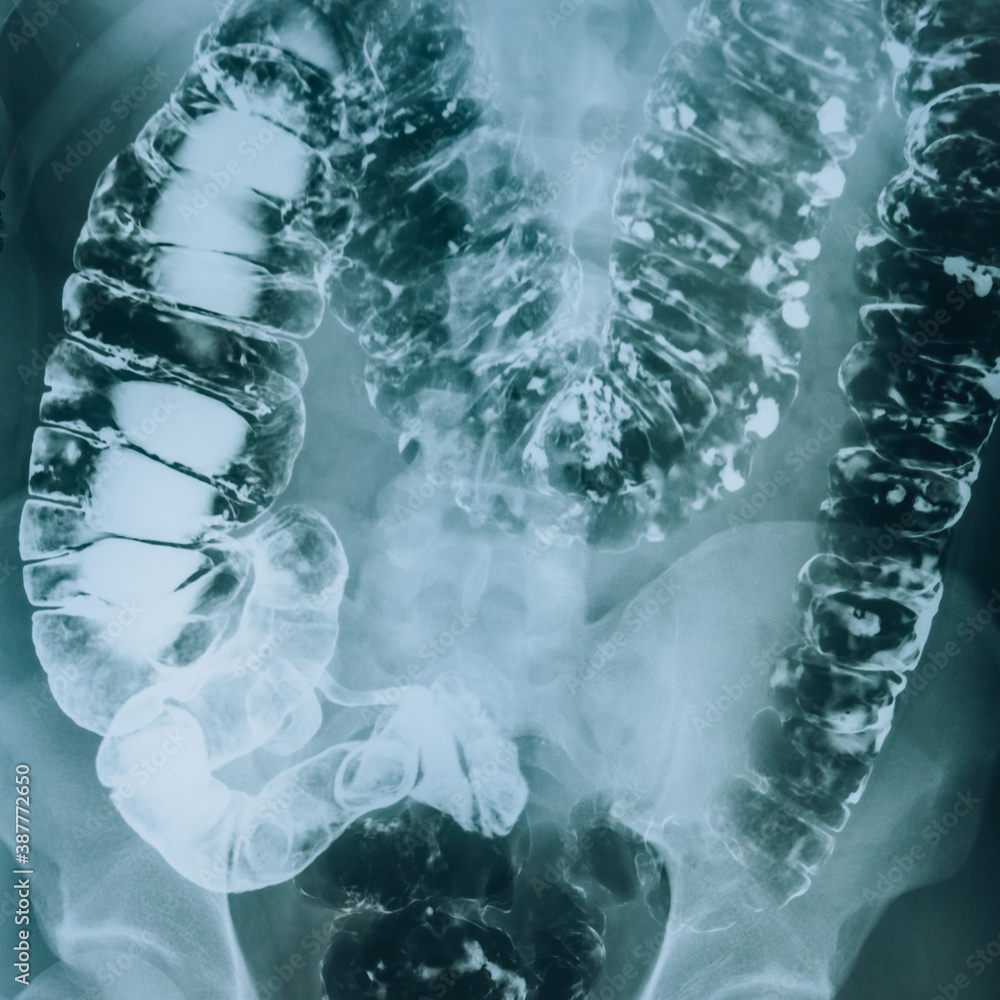 X-ray of the human intestine. Bowel diseases. Stock Photo | Adobe Stock