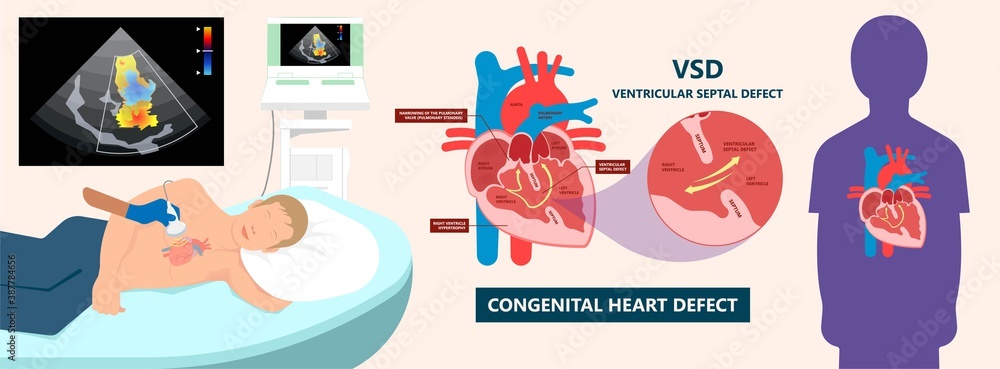 Poster Cath Lab Atrial Septal Defect Tetralogy of Fallot Patent Foramen ...