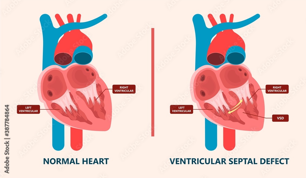 Cath Lab Atrial Septal Defect Tetralogy of Fallot Patent Foramen Ovale ...