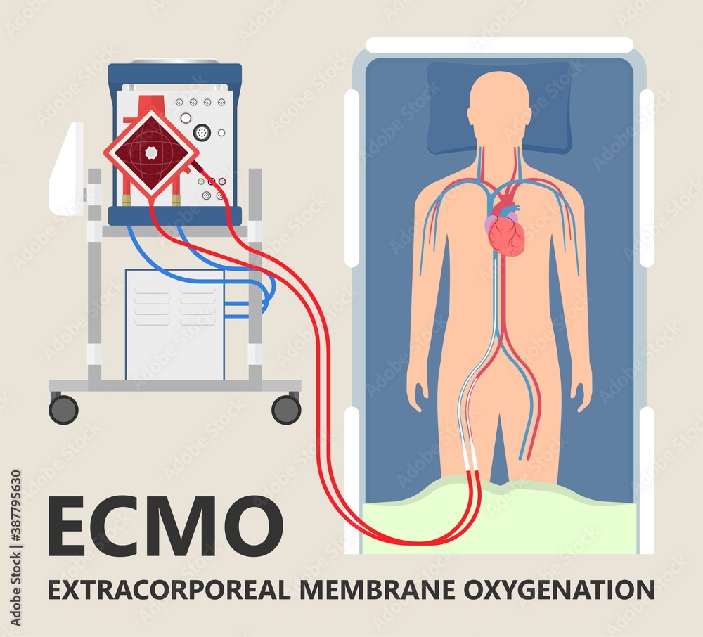Poster Extracorporeal membrane oxygenation ECMO a life support system ...