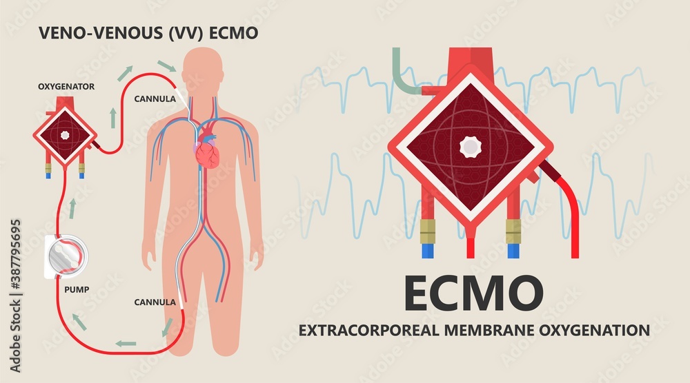 Extracorporeal membrane oxygenation ECMO a life support system for Respiratory failure patient ...