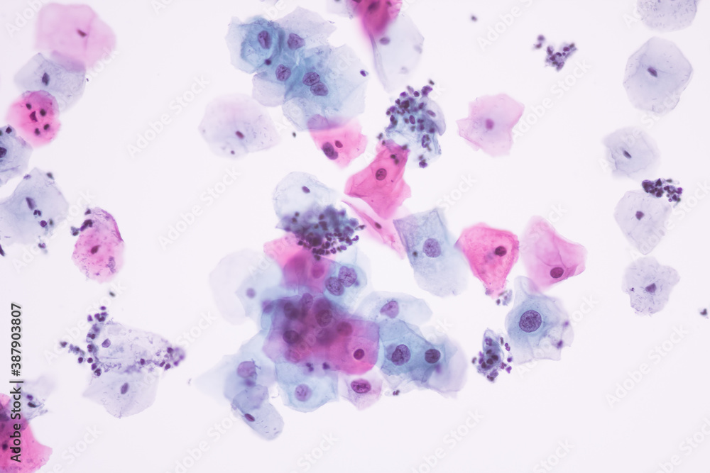 View in microscopic of Abnormal human cervix cells.Squamous epithelium ...