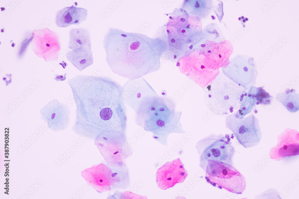 View in microscopic of Abnormal human cervix cells.Squamous epithelium cells.Superficial and ...