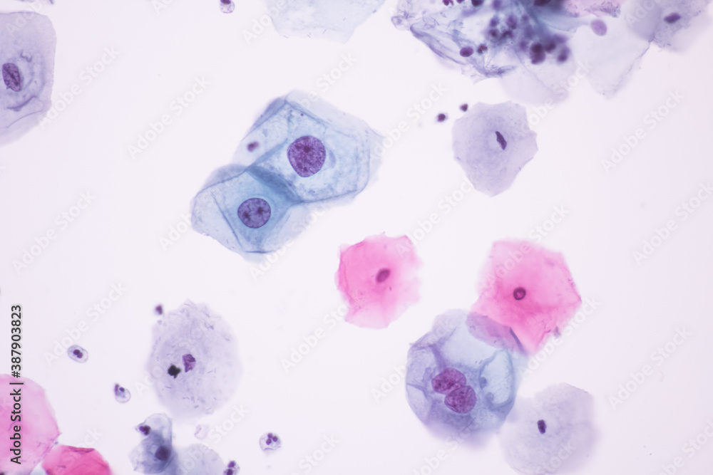 View in microscopic of Abnormal human cervix cells.Squamous epithelium ...
