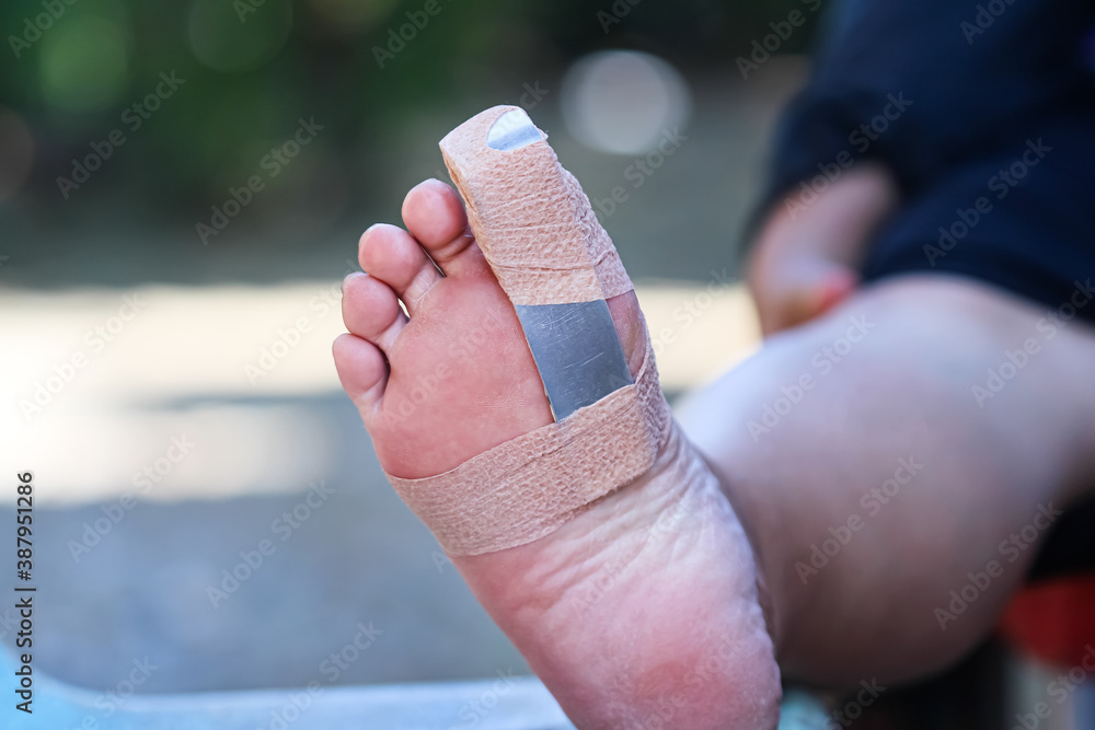 Splint foot , Asian woman big toe injury with medical splint and ...