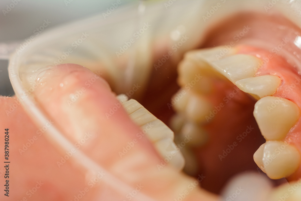 The dentist polishes the teeth with a drill, a dental procedure ...