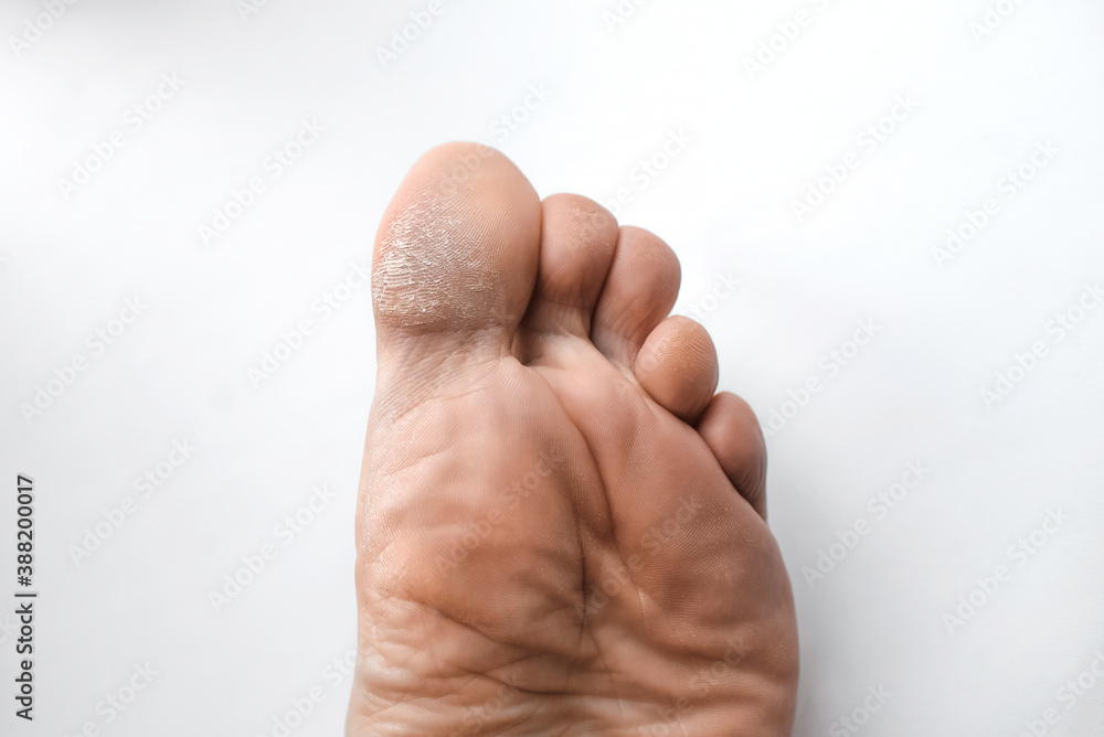 Male foot with corns and calluses, on a white background. Leg close up ...