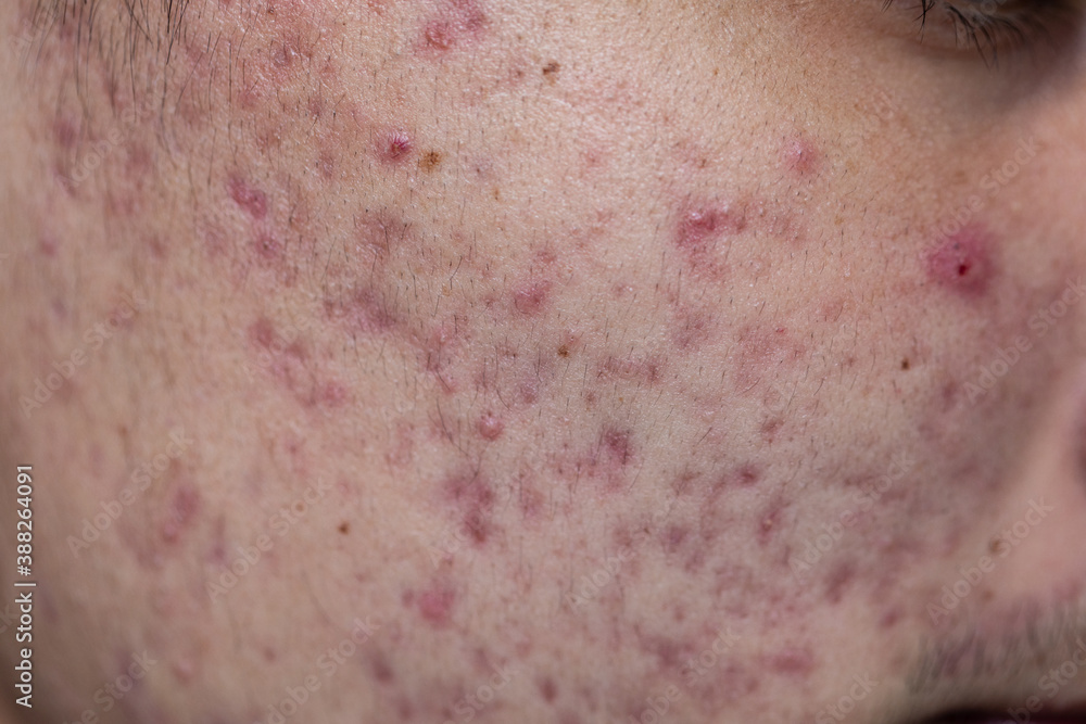 Backgrounds of lesions skin caused by acne on the face in the clinic ...