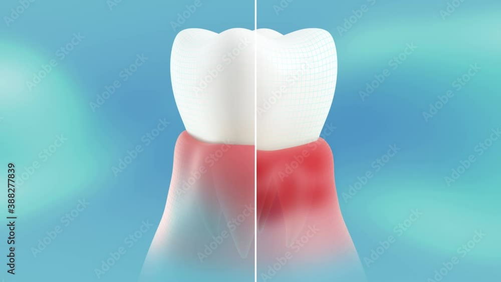 Periodontitis on the gums. Conceptual showing the dental cure of this ...