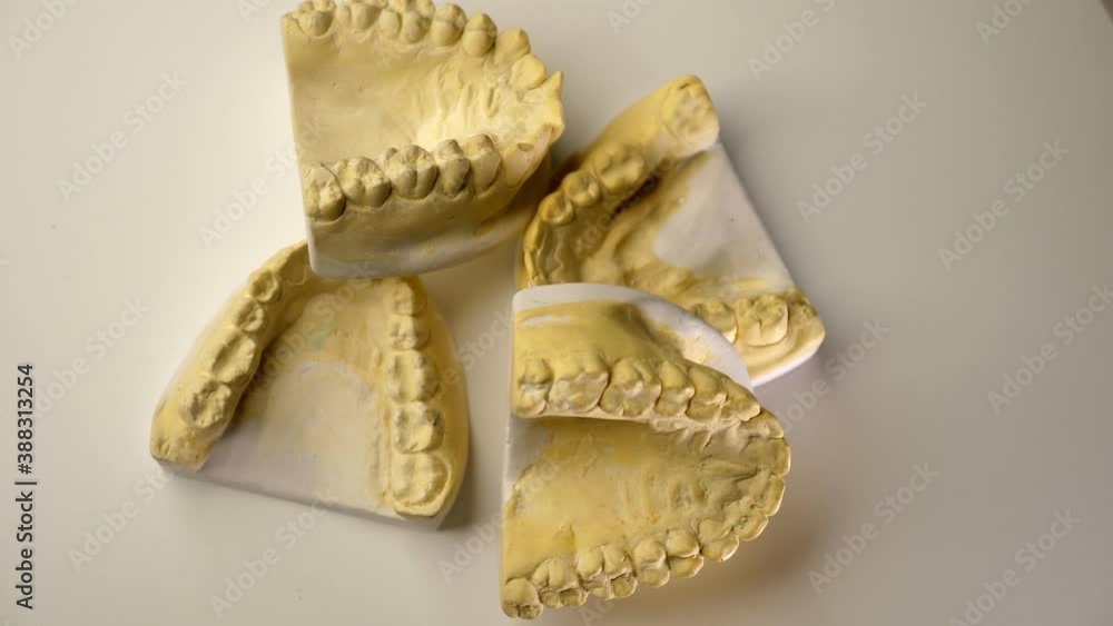 Video „Dental cast of teeth made of plaster for orthodontic treatment ...