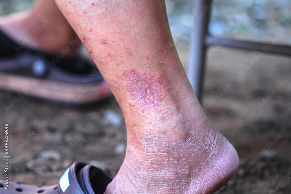 Close up asian woman has flaky and red rash infection on her ankle ...