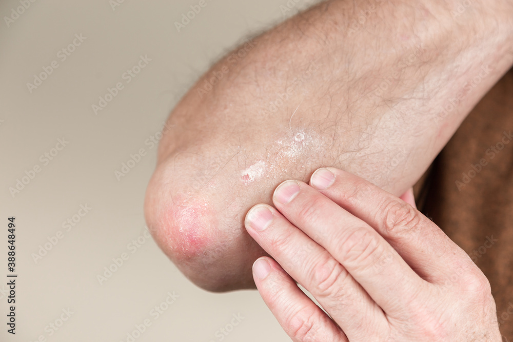 Psoriasis on the elbow. Closeup dermatitis on skin ill allergic rash ...