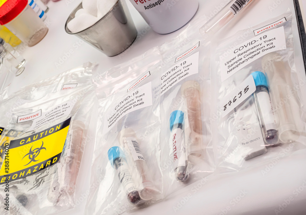 Blood samples from sars-cov2 infected people, preaparatives for Rt-PCR ...