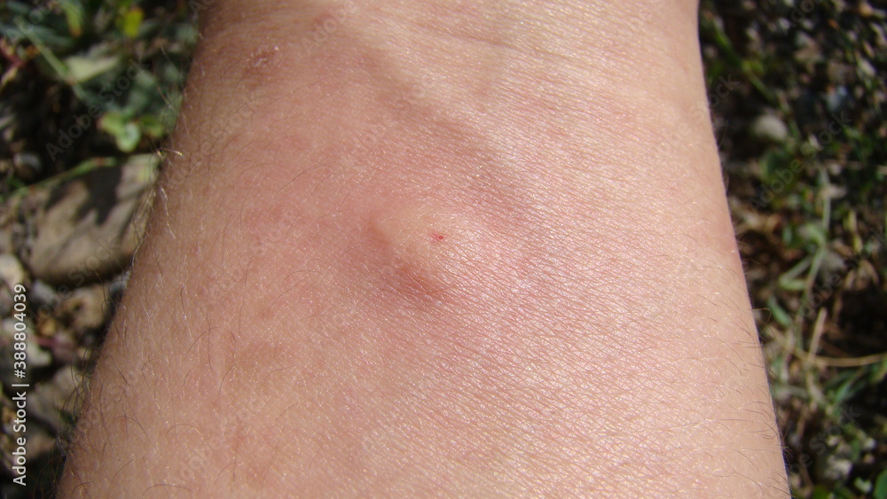 bee : stung by a bee worker. skin allergy , allergic treatment by honey ...