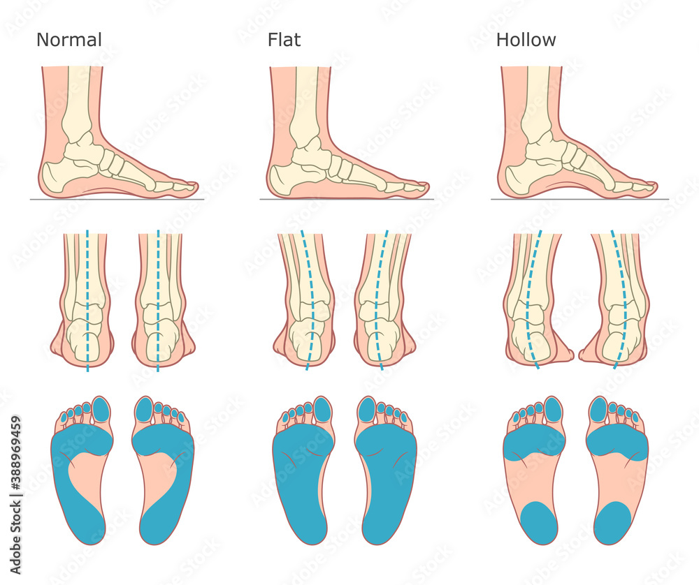 Poster Foot deformation types medical infographic. Vector illustration ...