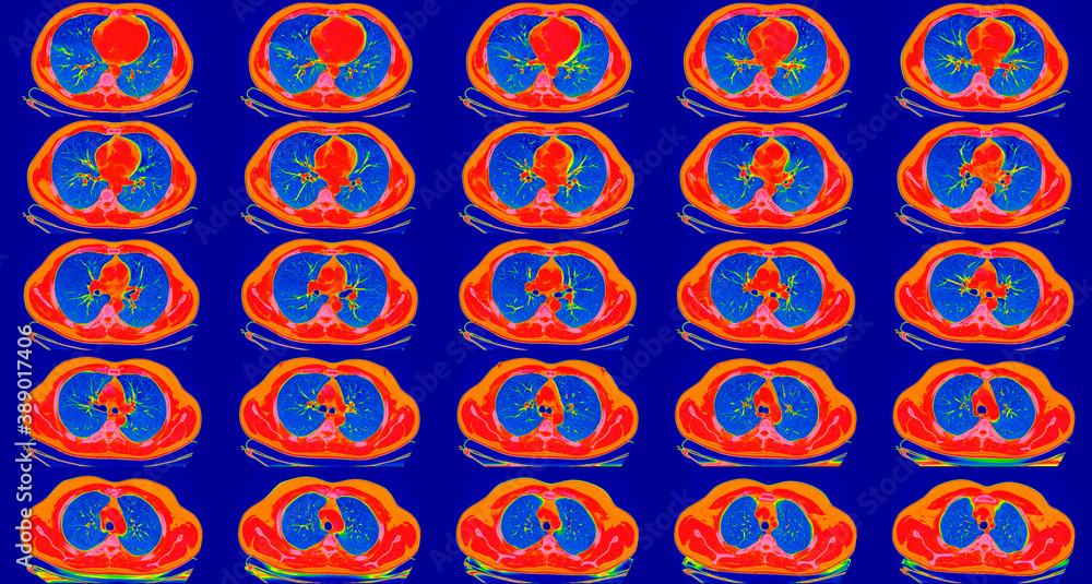 Computed tomography of the lungs in a healthy adult man. Normal lungs ...