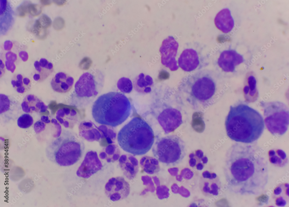 Mesothelial cells in body fluid sample. Stock Photo | Adobe Stock