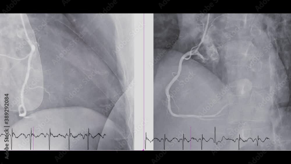 Coronary angiography is a test used to find out how much narrowing ...
