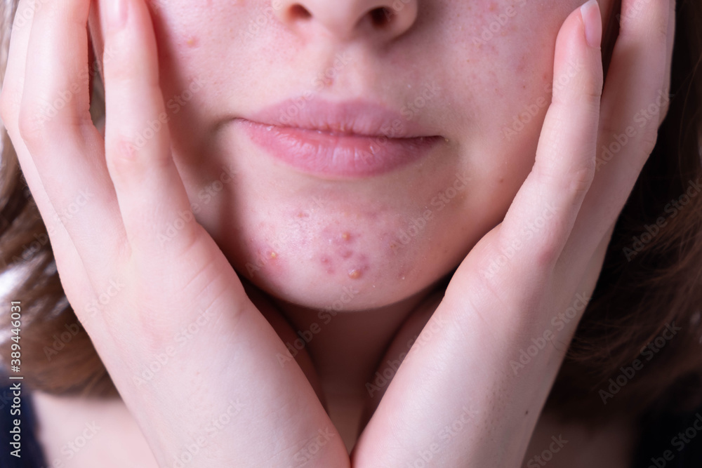Inflammatory acne rash sprinkled on teen girl chin in close-up Stock ...