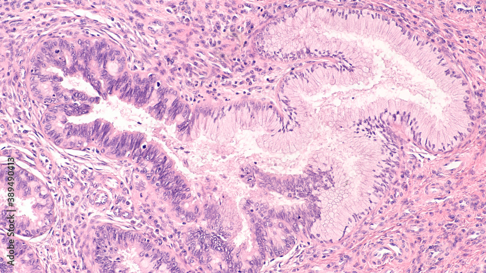 Cancer of cervix: cervical biopsy from a woman with an abnormal Pap ...