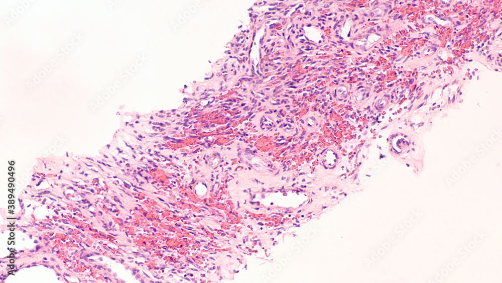 Kaposi's sarcoma is a type of cancer of blood vessels caused by a virus ...