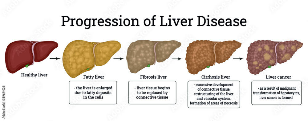 Stages of liver damage such as Fatty liver, Fibrosis, Cirrhosis, and ...