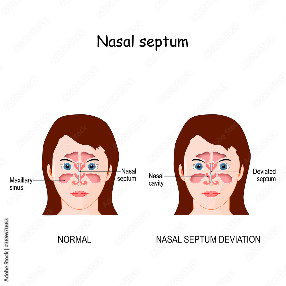 Nasal septum deviation Stock Vector | Adobe Stock