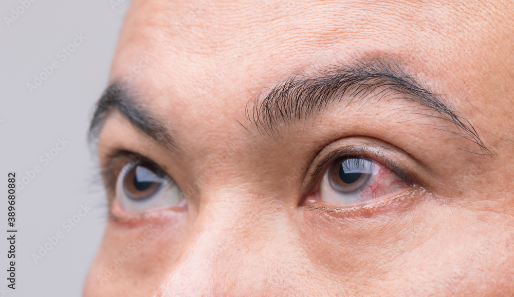 Eye irritation concept : Red eye of man, conjunctivitis eye or after ...