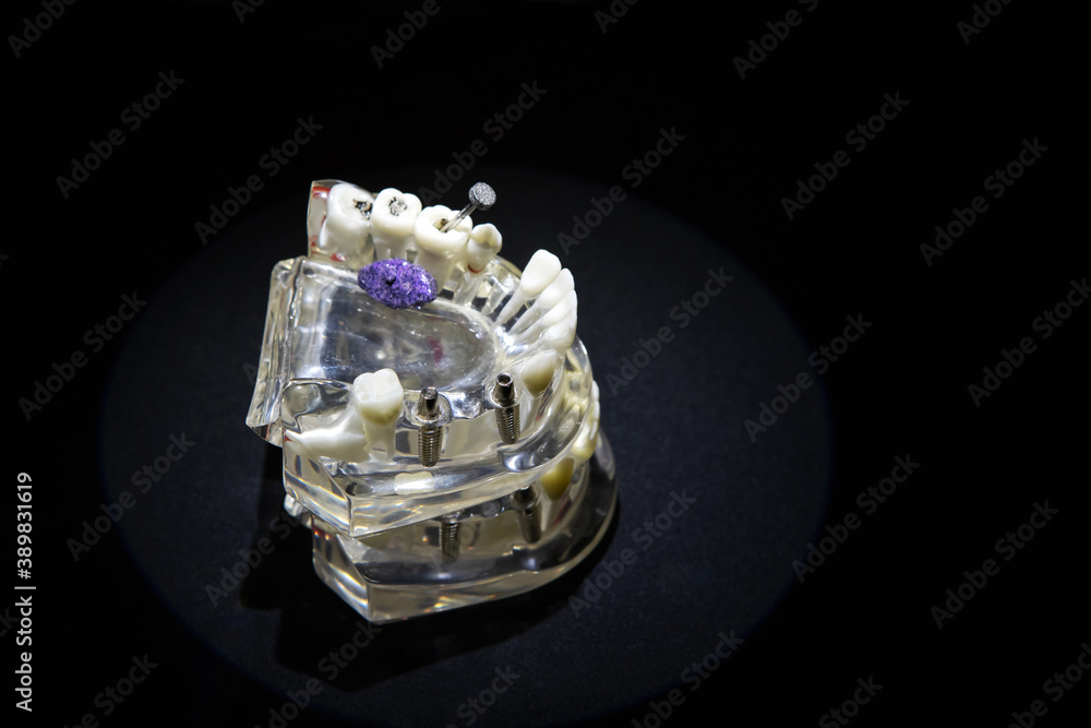 Titanium implants. A plastic model of the jaw with teeth for studying ...