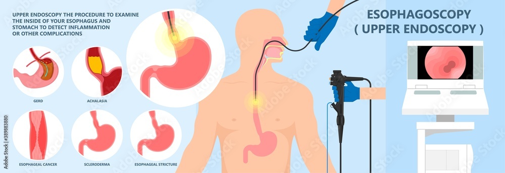 Dysphagia infection trachea examine Surgery choking gastric diagnose ...